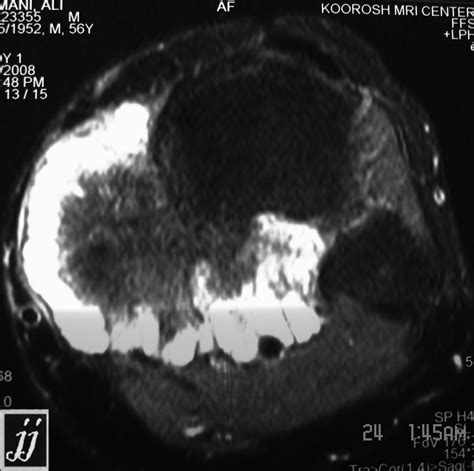 Tibia Osteosarcoma Above Exostosis Radiopaedia
