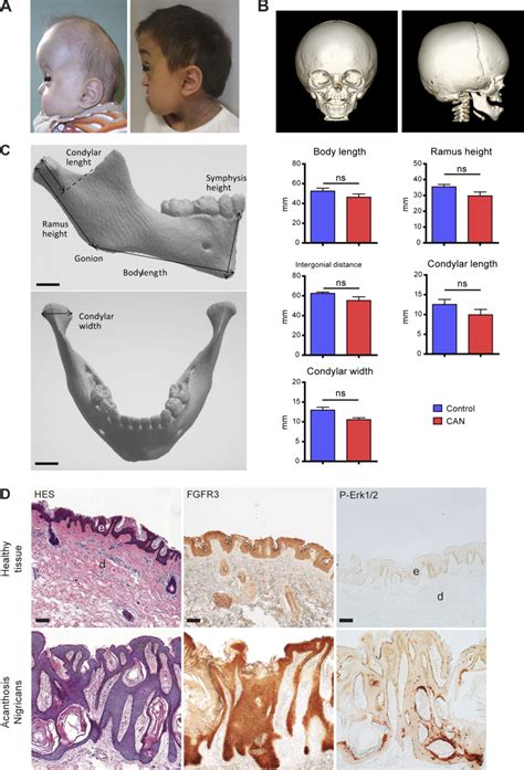 Clinical Features Of Can A Craniofacial Features Of Can Patient 1 Download Scientific