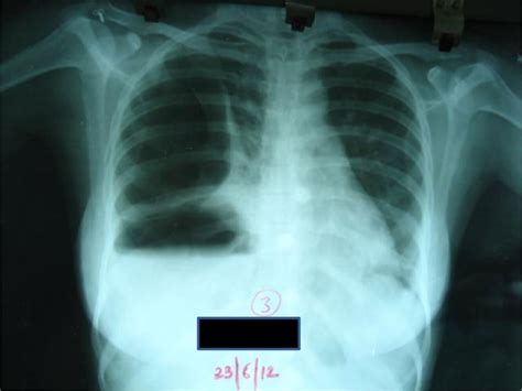 Pyopneumothorax Following Suicidal Kerosene Ingestion Bmj Case Reports
