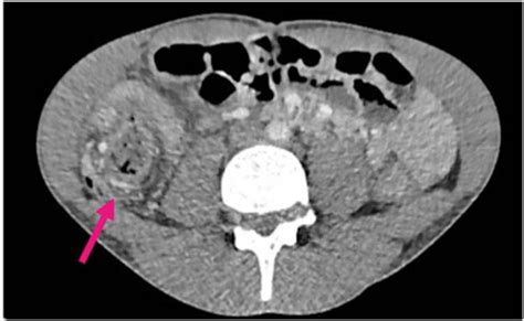 Contrast Ct Axial Sections Showing The Enhanced Thickened Appendix