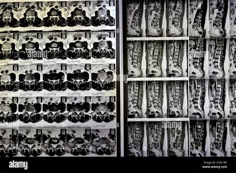Mri Lumbosacral Spine Without Contrast Revealed Back Muscle Spasm Mild