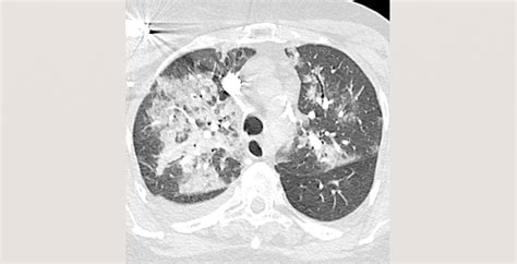 Viral Pneumonia Radiology From Chest Team Viral Pneumonia