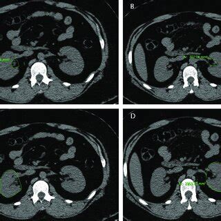 A Control Year Old Male Patient Performed CT Pelvi Abdominal Download Scientific Diagram