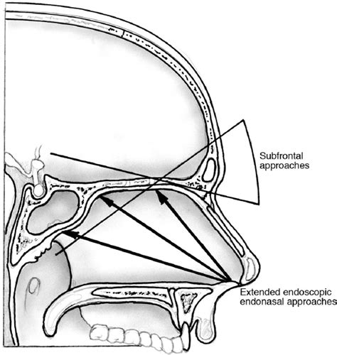 Transcranial Approaches To The Skull Base Neupsy Key
