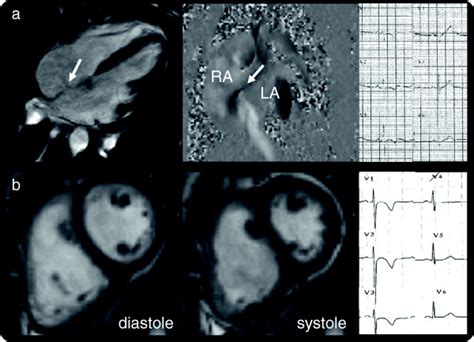 Right Ventricular Overload A Volume Loading From An Atrial Septal