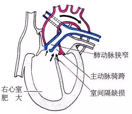 法洛四联症 百度百科