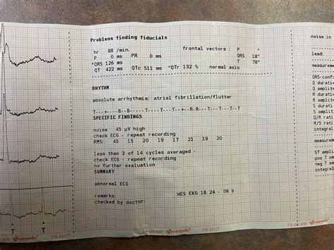 Flutter Or Fibrillation R Ecg