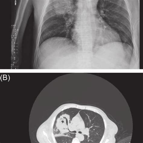 A Well Circumscribed Opacity In The Right Upper Lobe Of The Chest Download Scientific
