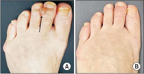 Excision With Temporary Interphalangeal Joint Pin Fixation For Toe