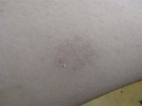 Появилось пятно на ноге Здравствуйте недели 2 назад на ноге появилось Medaboutme