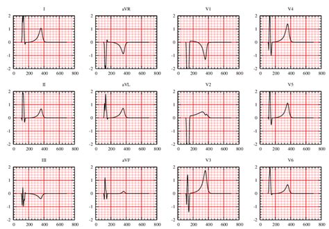 An Example Of A Computational Ecg Obtained With The Model Of §2