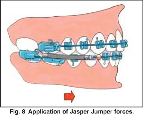 Figure 8 From Interarch Maxillary Molar Distalization Appliances For Class Ii Correction