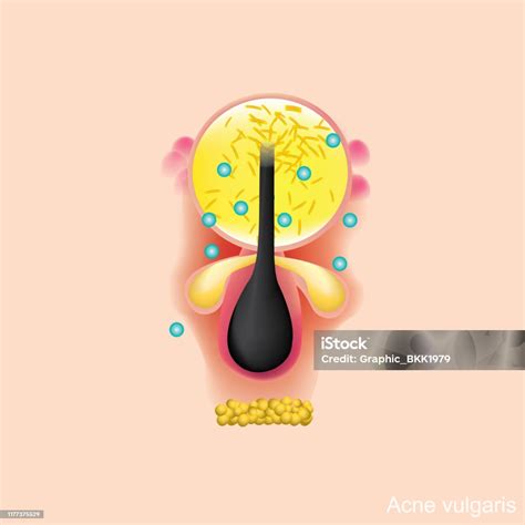 여드름 Vulgarise는 머리 여포가 죽은 피부 세포 및 피부에서 기름으로 막힐 때 생기는 장기 피부 질병입니다 여드름은 블랙