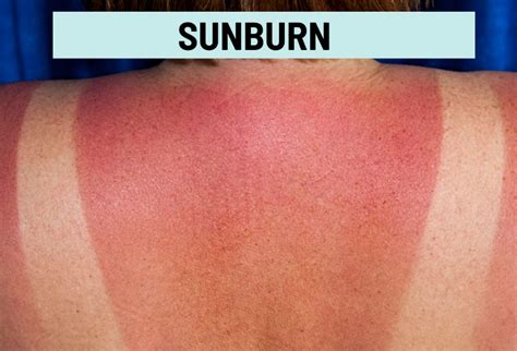 Skin Inflammation Pictures Types Causes And Treatment