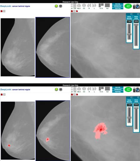 Another Malignant Mass Revealed In Dense Breast Tissue Top Image Deeplook Overlay Turned Off