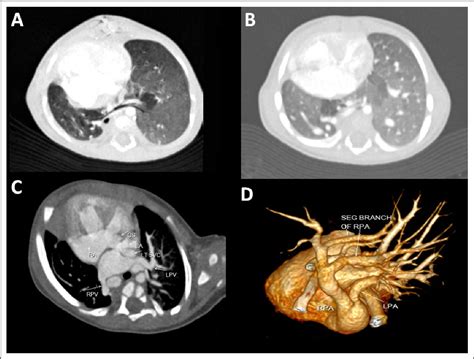 Partial Defect Of Atrioventricular Canal Semantic Scholar