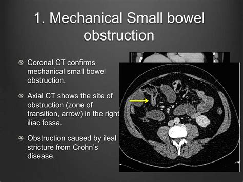 Approach To Pfa Interpretation Pptx Digestive Disorders Diseases