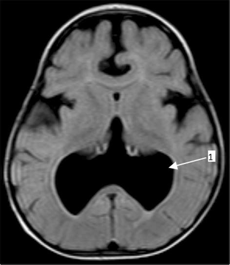 Holoprosencephaly Mri
