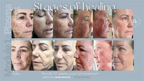 How To Take Perfect Before And After Pictures For Plasma Fibroblast