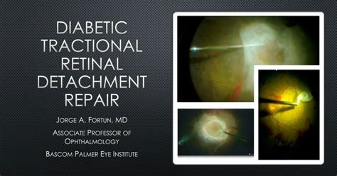 Video Surgeon Discusses Techniques For Diabetic Tractional Retinal Detachment Repair