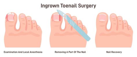 Effective Removal Of Ingrown Nail Your Comprehensive Guide To