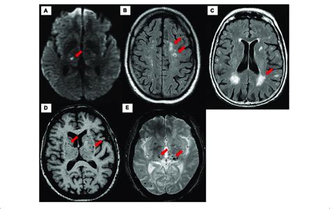 Neuroimaging Classification Of Csvd Based On Strive A Recent Small Download Scientific