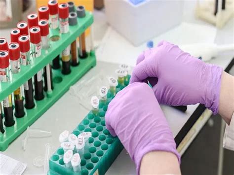Skims To Start Free Of Cost Hiv Viral Load Testing Mou Signed Daily