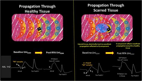 Po 02 002 Comparison Of Unipolar Electrogram Monitoring During Radiofrequency Ablation In Viable