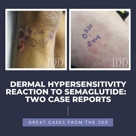 Jdd Vault Case Report On Dermal Hypersensitivity And Glp 1 Agonists