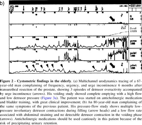 Scielo Brasil Voiding Dysfunction And Urodynamic Abnormalities In Elderly Patients Voiding