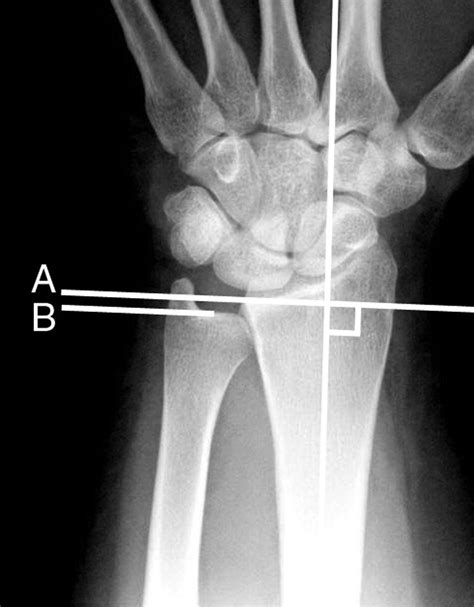 Ulnar