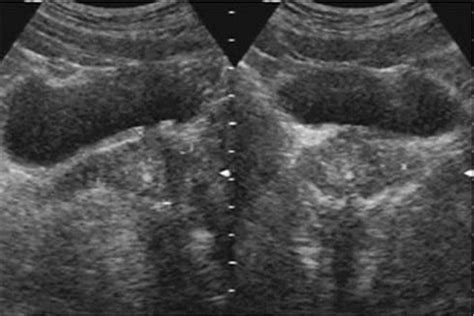 Media De Volumen Prost Tico Por Ecograf A Suprap Bica En J Venes Sanos Del Estado De Morelos En