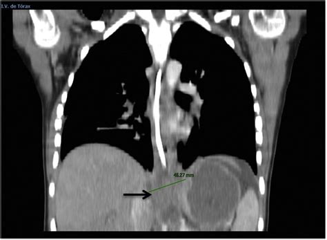 Pseudoacalasia Como Presentación De Un Tumor Pediátrico Anales De