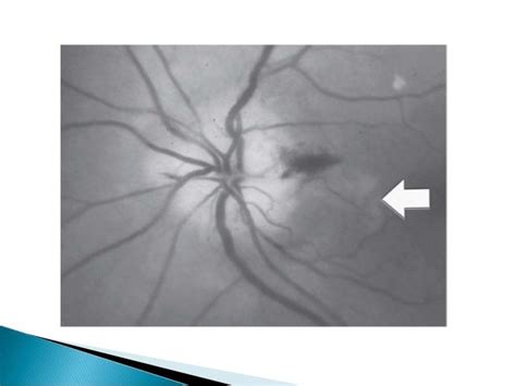 Approach To Monocular Blindness