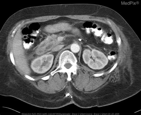 Pancreatic Divisum Radiology