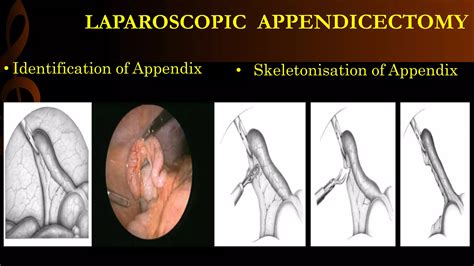 Laparoscopic Appendicectomy Operative Surgery Pptx