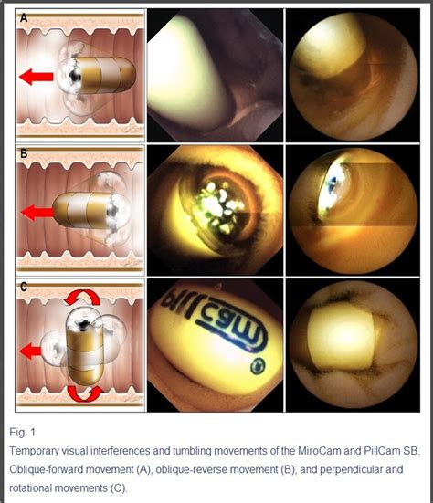 캡슐내시경 진료하는곳 캡슐내시경 원리와 촬영모습 네이버 블로그