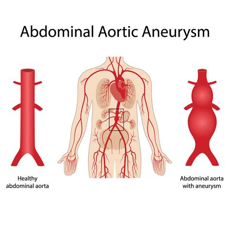 Abdominal Aortic Aneurysm Vejthani International Hospital Jci