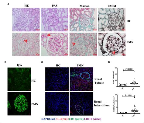 Cd3 T Cells Were Adjacent To Cd11b Cells In Pmn Patients
