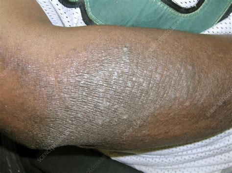 Lichen Simplex Chronicus Stock Image C0608448 Science Photo Library