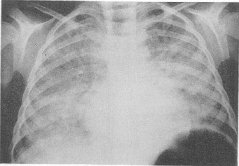 Hampton New Hampshire Mad Dog Democrat Measles Influenza Covid