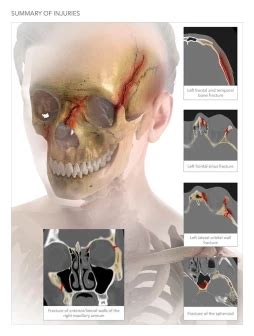 Facial Bone Fractures