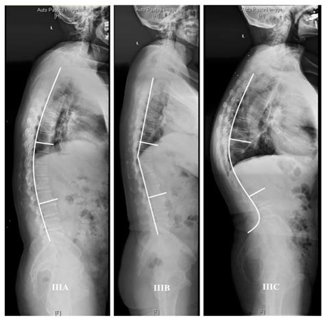 Thoracolumbar Lumbar Degenerative Kyphosis—the Importance Of