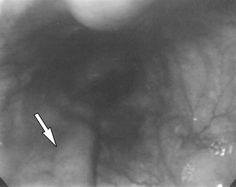 Esophageal Varices History And Physical At Ricardo Lafayette Blog