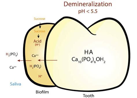 Caries Process And Prevention Strategies Demineralization