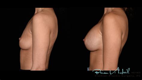 Breast Augmentation Before And After Premier Plastic Surgery
