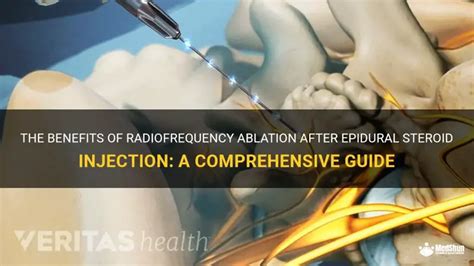 The Benefits Of Radiofrequency Ablation After Epidural Steroid