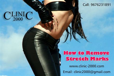 How To Remove Stretch Marks Clinic