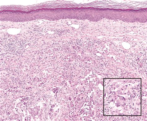 Rapidly Growing Scalp Nodule Mdedge Dermatology