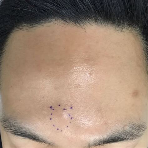 Forehead Lipoma Removal Causes And Expert Treatment